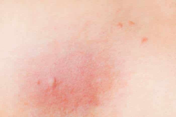 Come riconoscere le punture di cimici da letto